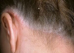 Psoriasis sur la tête - Dr. DERM